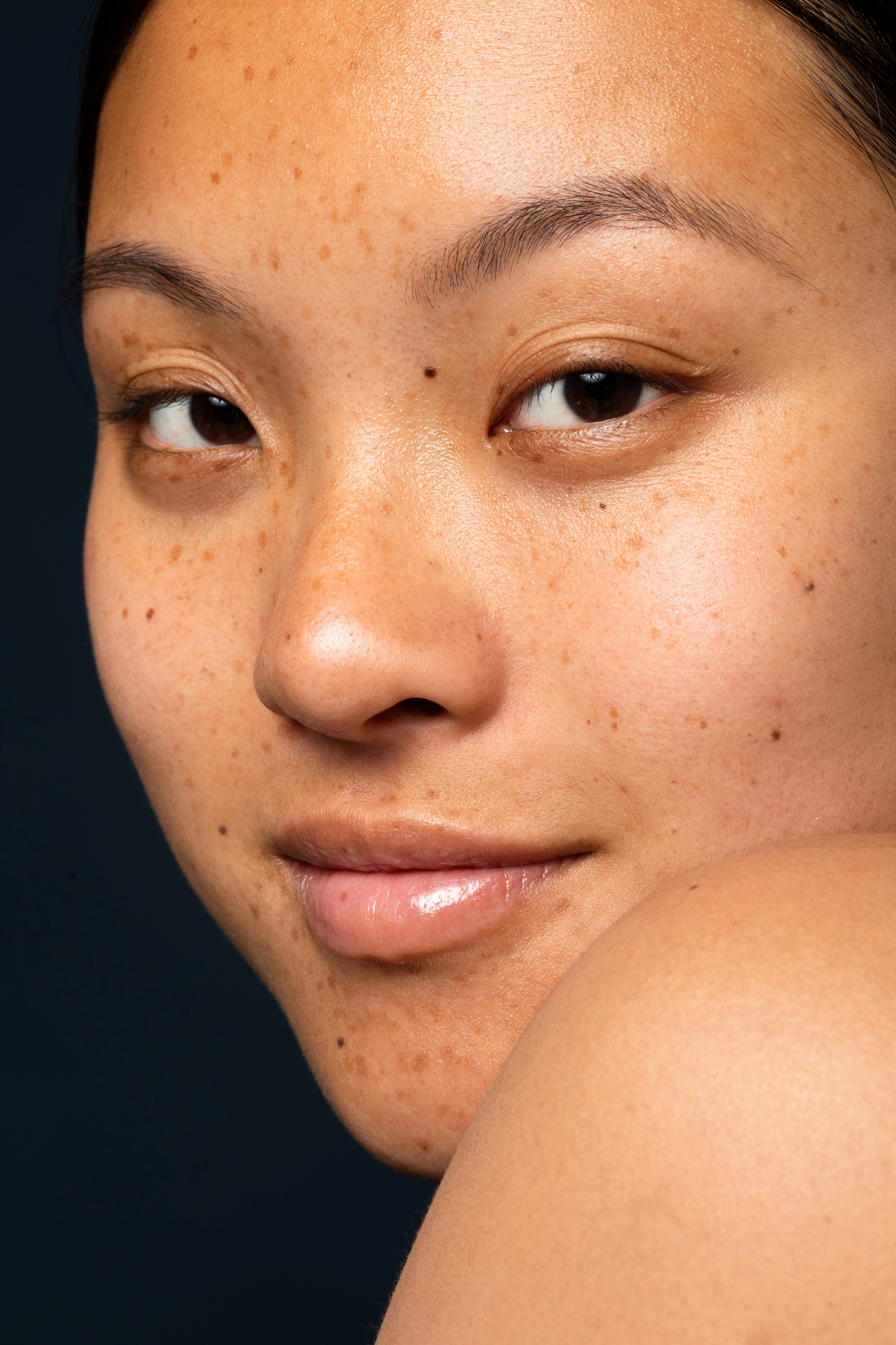 Freckles: What Is It, Causes, Types and Treatment Options