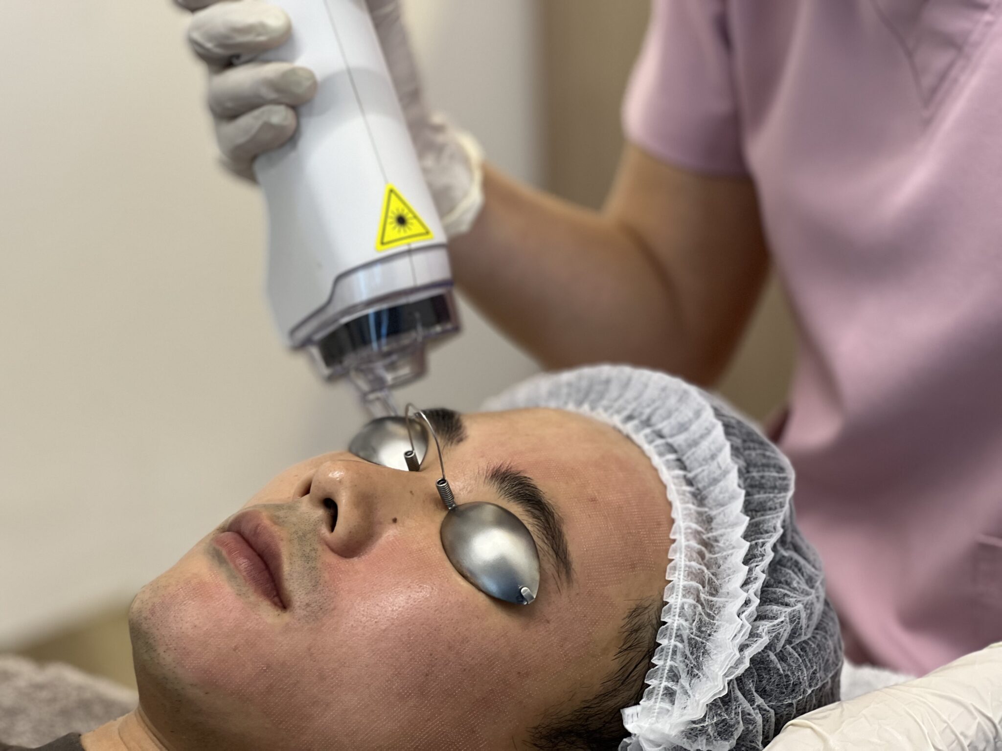 Ice Pick Scars: What Is It, Causes and Treatment