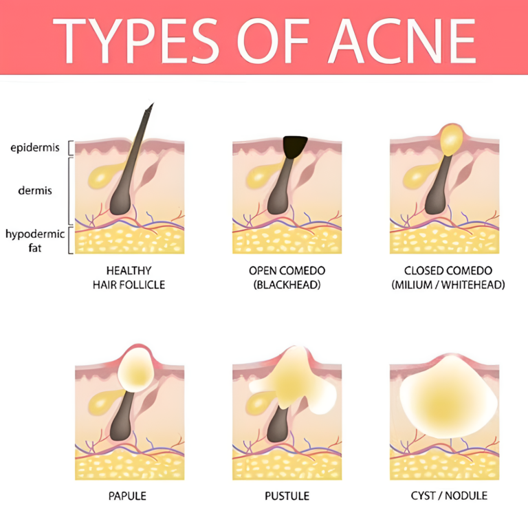 Acne: Causes, Symptoms, and Treatment