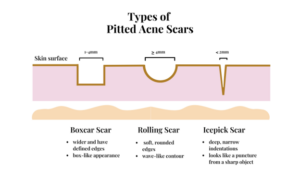Pitted Acne Scars: What Is It, Types, Causes & Treatment Options